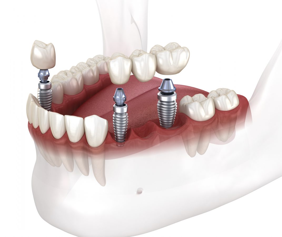 Tooth Extraction And Dental Implants | Santa Rosa, CA