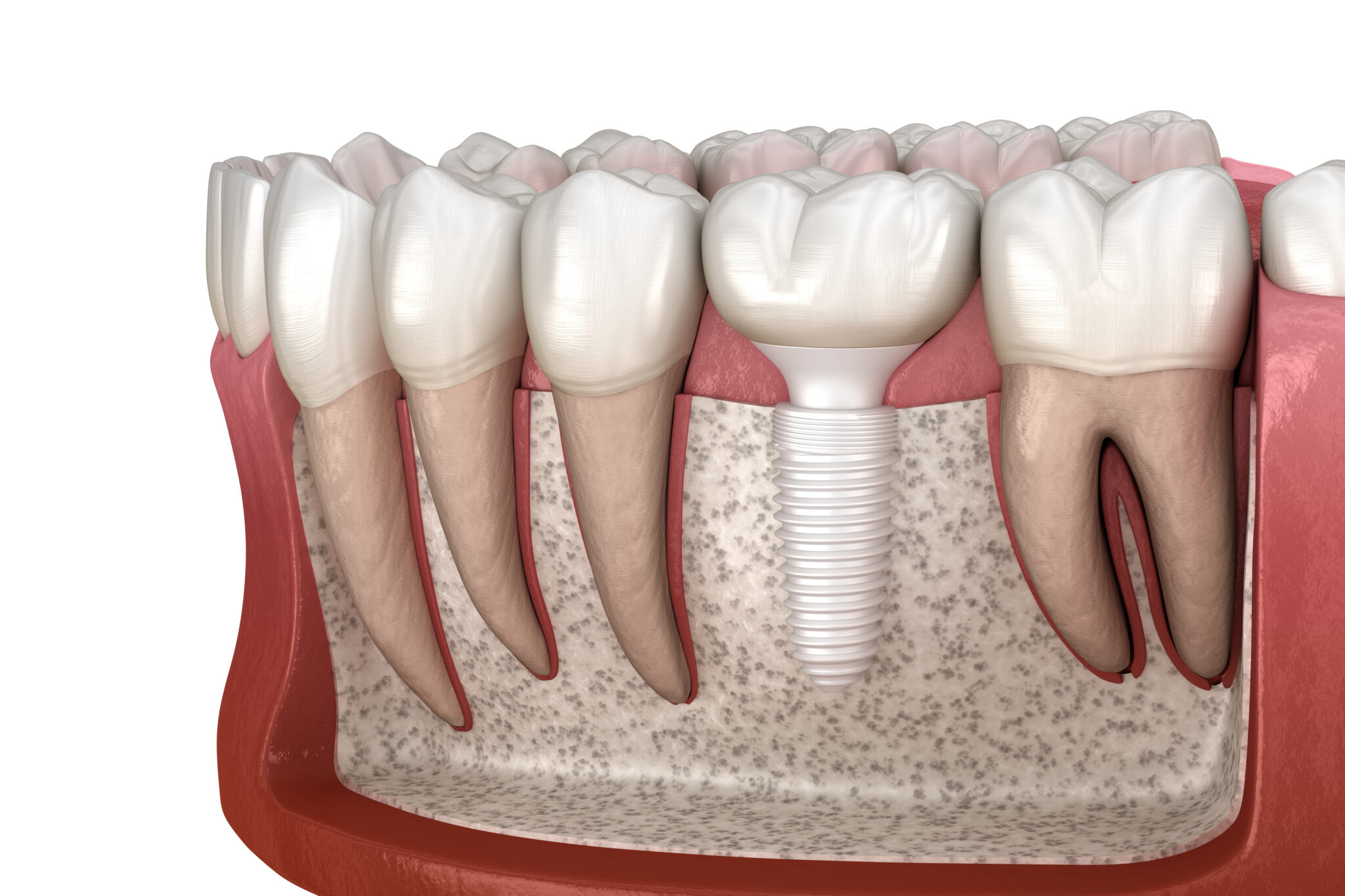 Placing A Lifelike Implants And Crowns | Santa Rosa, CA