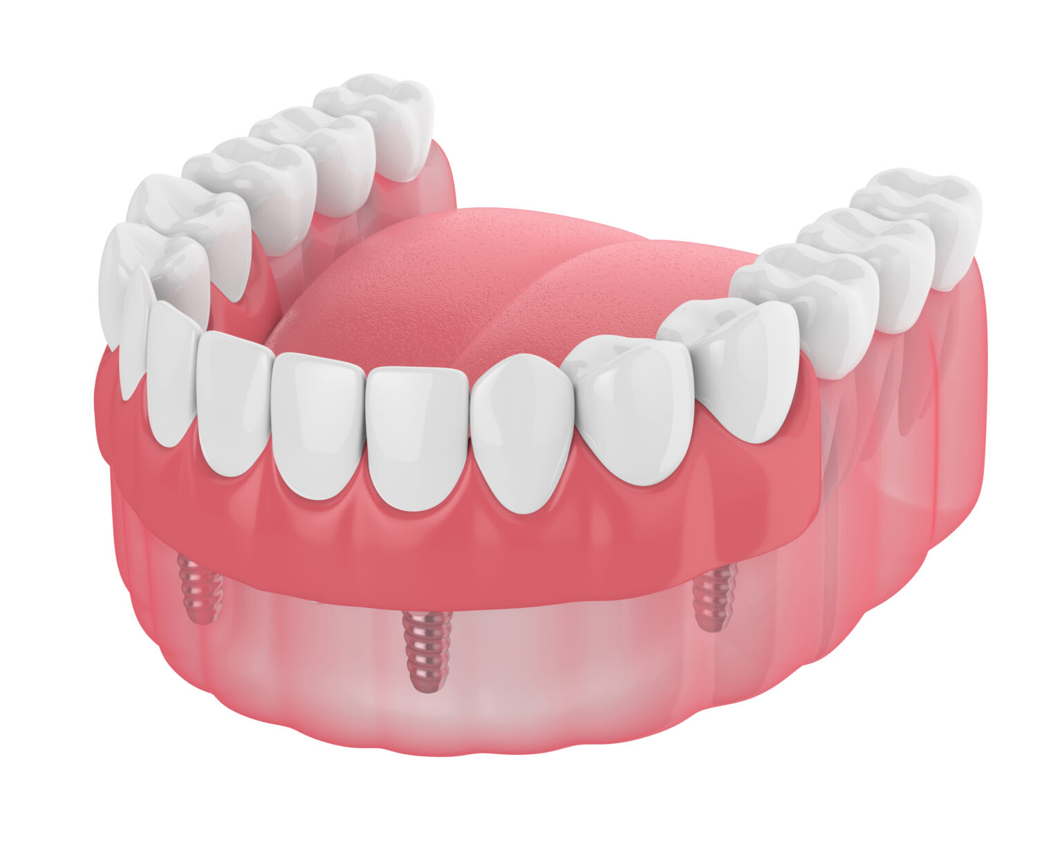 Securing Partials With Dental Implants | Santa Rosa, CA