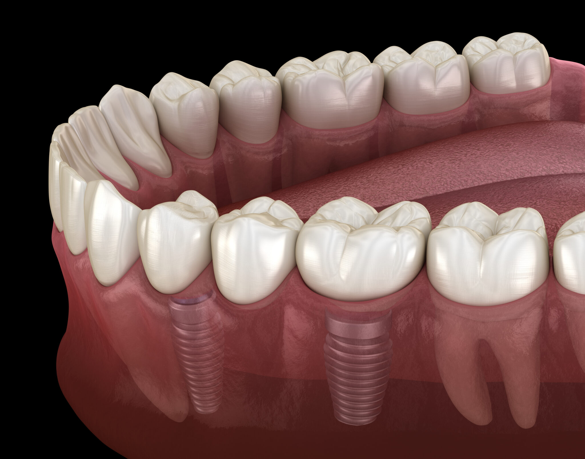 Bridges Last Longer With Dental Implants | Santa Rosa, CA