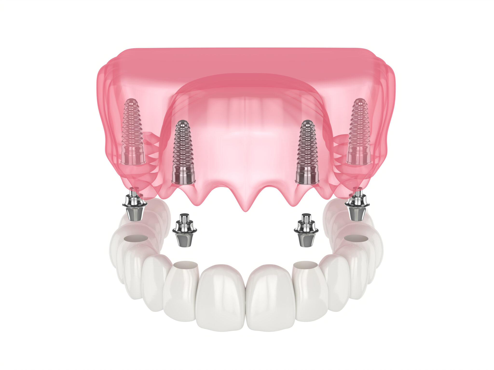 A Full Smile With Ridge Preservation | Santa Rosa, CA