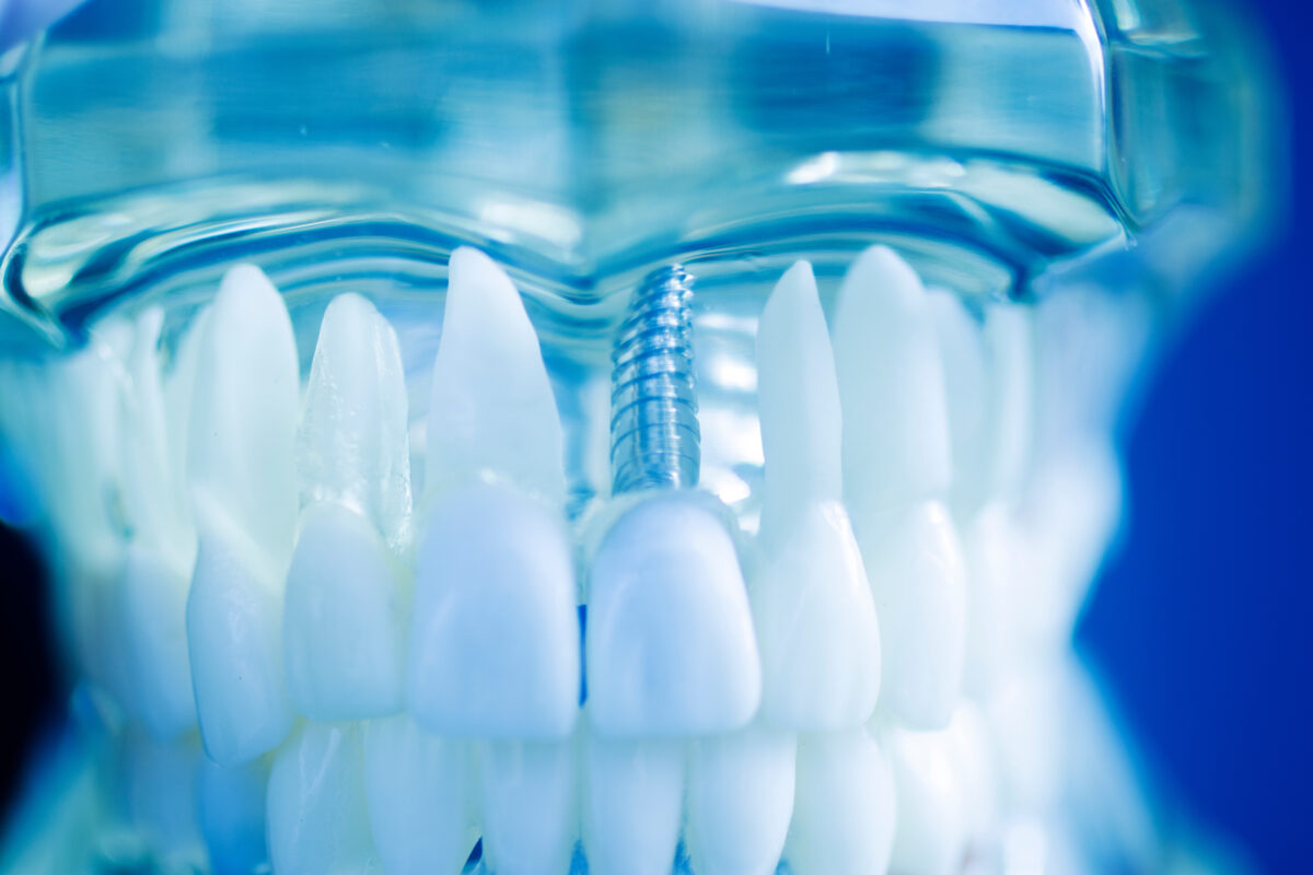 The Benefits Of Straumann® Dental Implants | Santa Rosa, CA