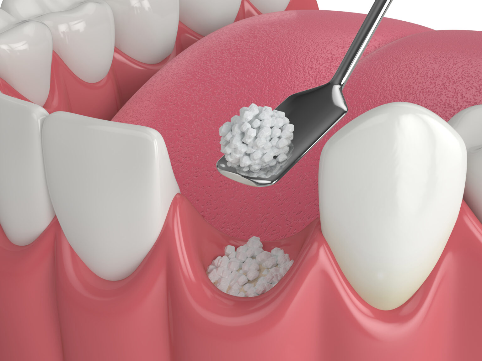 Ridge Preservation Following Tooth Loss | Santa Rosa, CA