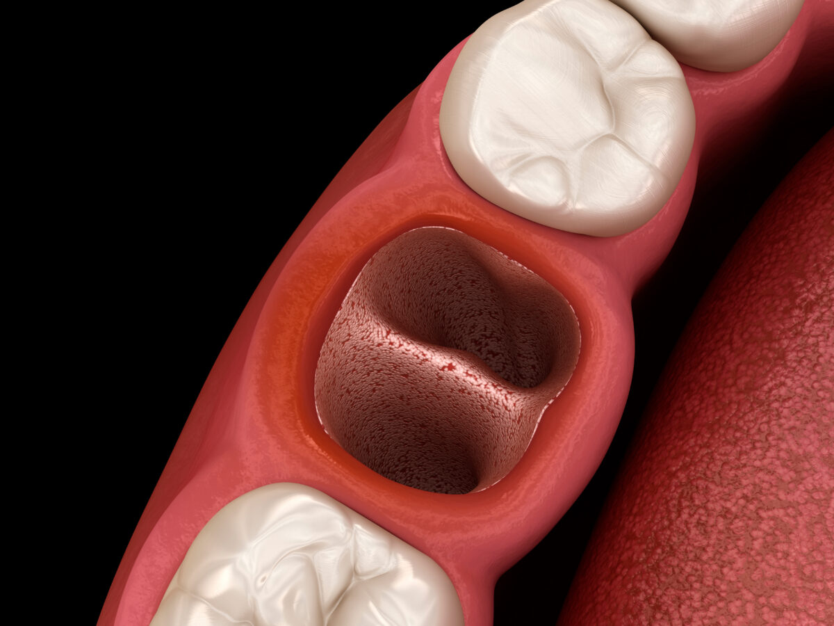 Preparing Smiles With Tooth Extraction | Santa Rosa, CA