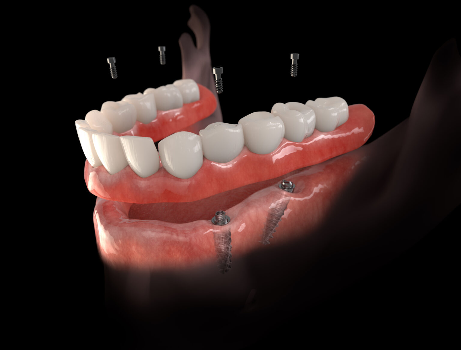 Ready For Custom Fixed Implant Dentures? | Santa Rosa, CA