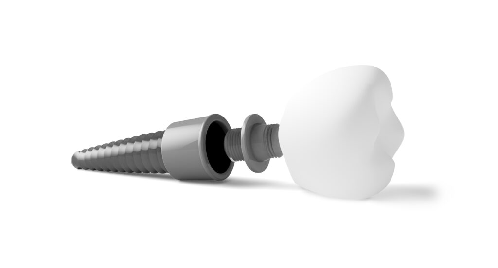 Better Implants With Straumann Technology | Santa Rosa, CA