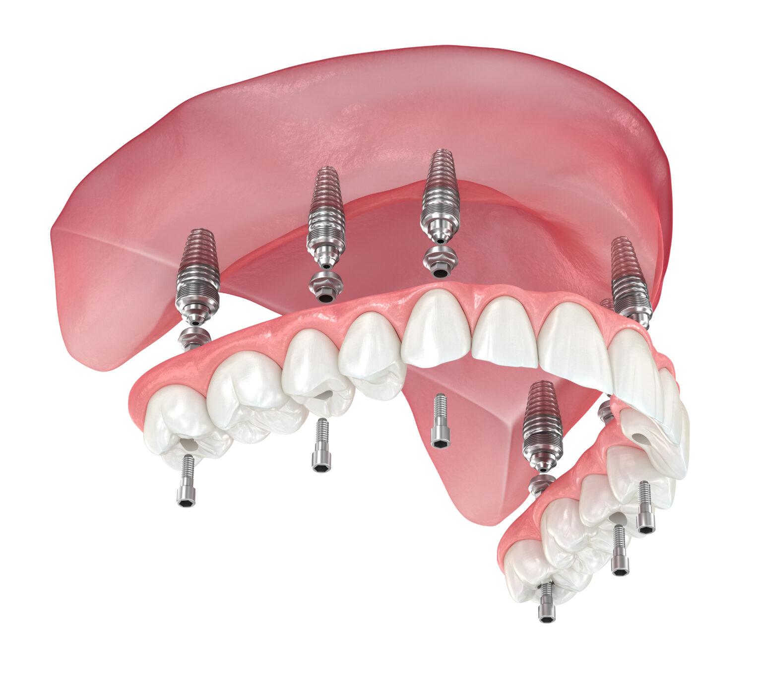 Full Arch Restoration With Dental Implants | Santa Rosa, CA