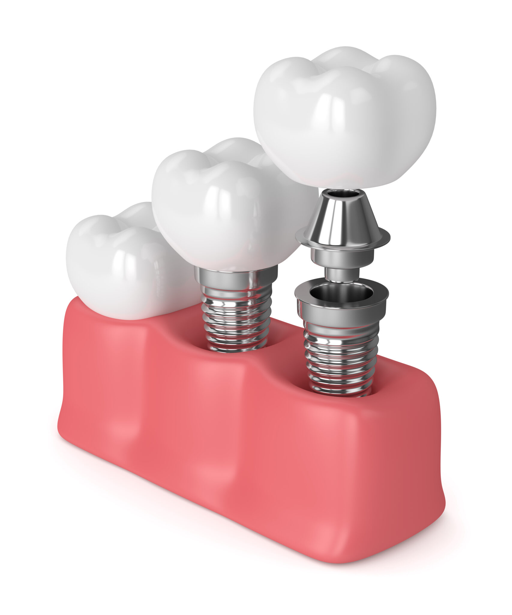 Using Advanced Technology For Implants| Santa Rosa, CA