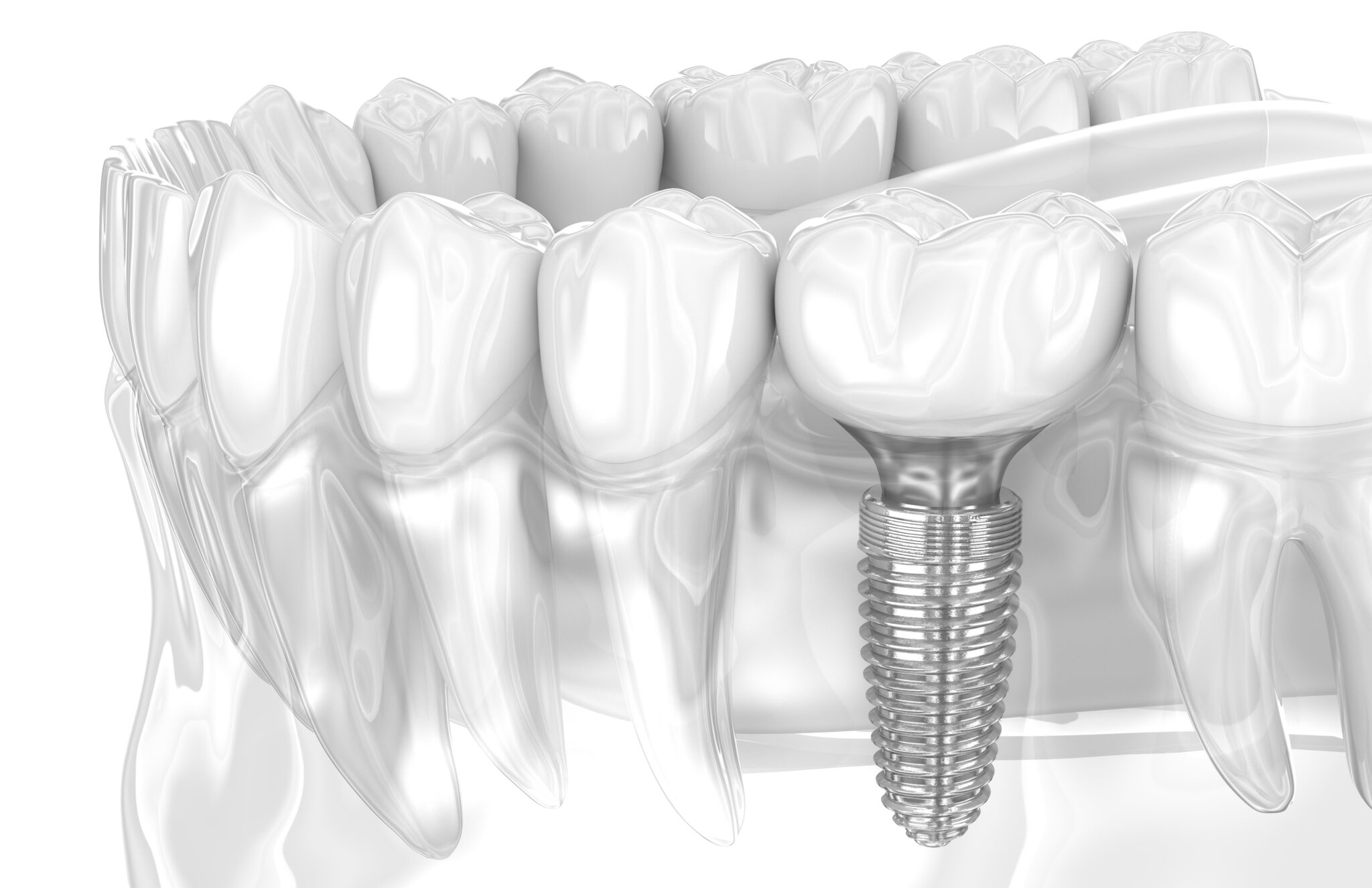 Planning Implant Placement With Digital Tech | Santa Rosa, CA