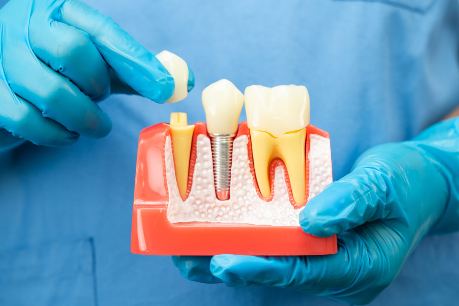 How We Prepare Your Jaw For Dental Implants | Santa Rosa, CA